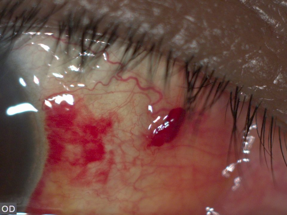 Conjunctival Hemorrhage - ROQUE Eye Clinic | Eye.com.ph