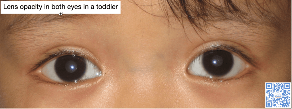Cataract in Children | Roque Eye Clinic