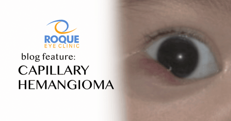 Capillary Hemangioma | Strawberry Nevus | Roque Eye Clinic