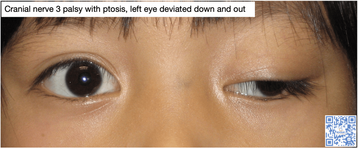 Cranial Nerve Palsy | 3rd nerve palsy | 4th nerve palsy | 6th nerve palsy