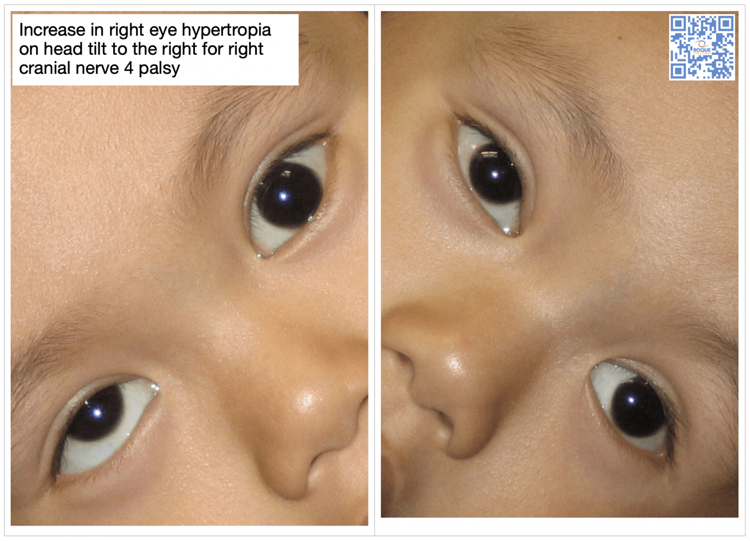 Cranial Nerve Palsy | 3rd nerve palsy | 4th nerve palsy | 6th nerve palsy