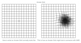 Comprehensive Guide to the Amsler Grid Test | Roque Eye Clinic