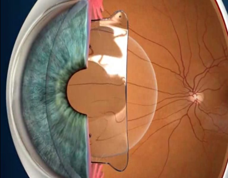 EVO Visian ICL - ROQUE Eye Clinic | Eye.com.ph | Manila, Philippines