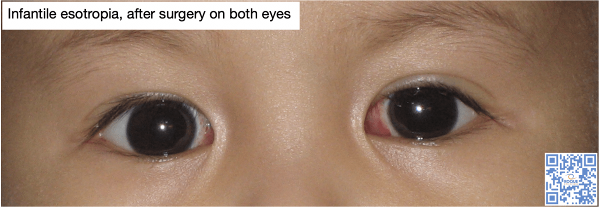 Infantile Esotropia - ROQUE Eye Clinic | Eye.com.ph