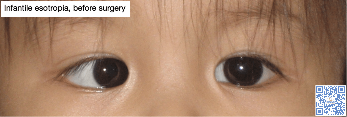 Infantile Esotropia - ROQUE Eye Clinic | Eye.com.ph