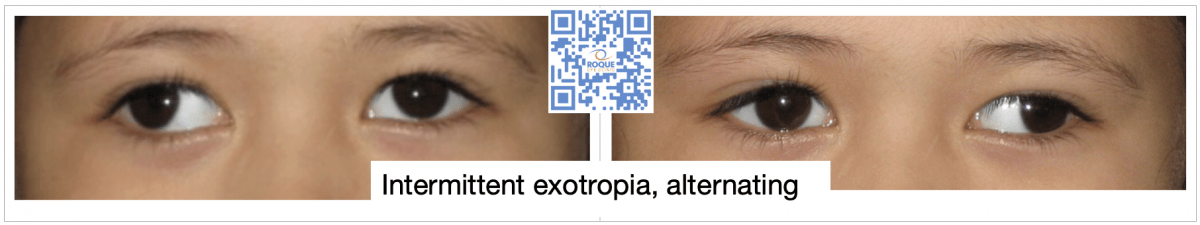 Intermittent Exotropia - ROQUE Eye Clinic | Eye.com.ph