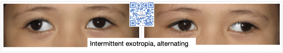 Intermittent Exotropia - ROQUE Eye Clinic | Eye.com.ph