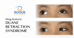 Duane Retraction Syndrome | Goldenhar, Moebius, Morning Glory