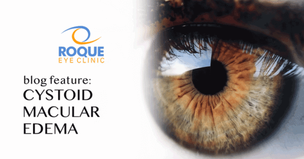 Cystoid Macular Edema (CME) | Roque Eye Clinic