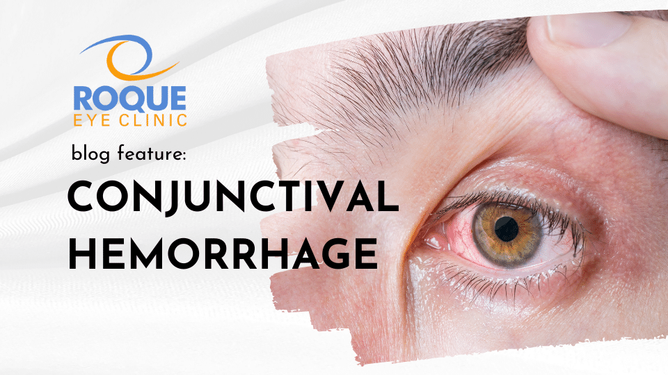 Conjunctival Hemorrhage - ROQUE Eye Clinic | Eye.com.ph