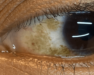 Conjunctival Nevus - Eye Freckle Laser Removal