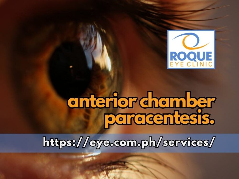 Anterior chamber paracentesis Archives - ROQUE Eye Clinic | Eye.com.ph