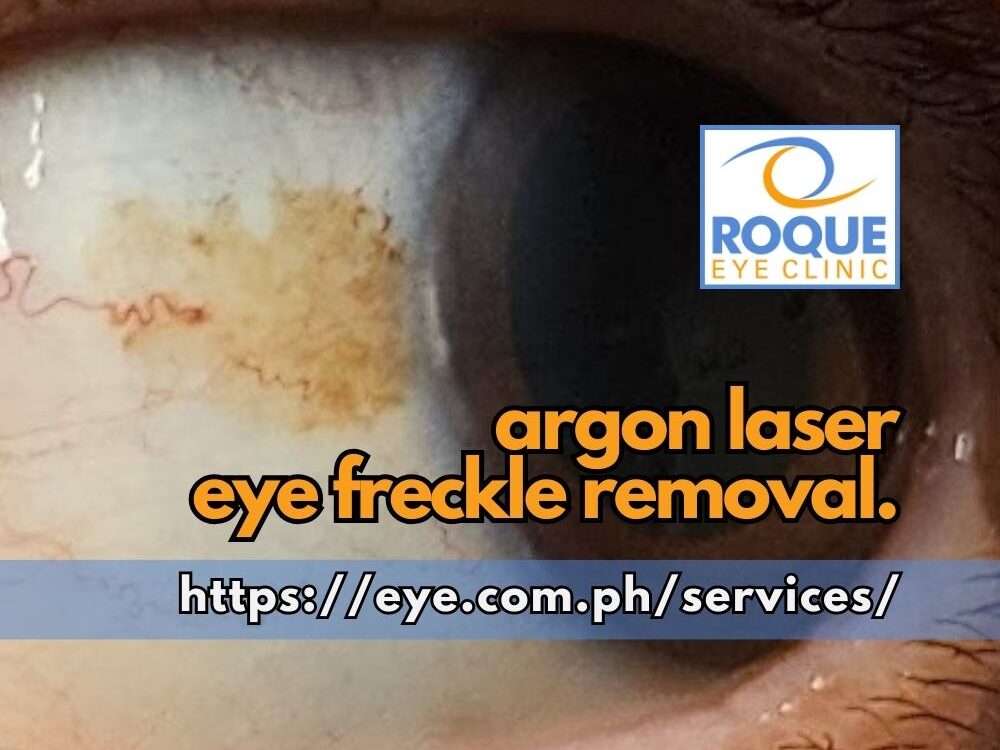 ARGON Laser Photocoagulation - ROQUE Eye Clinic | Eye.com.ph