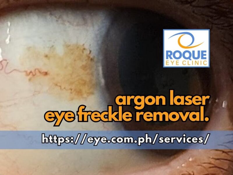 Strabismus Surgery - ROQUE Eye Clinic | Eye.com.ph