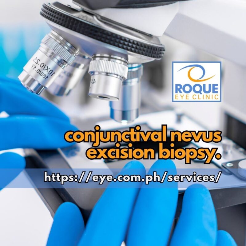Conjunctival Nevus Excision Biopsy