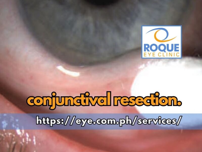 Phacoemulsification Cataract Surgery - PREMIUM - ROQUE Eye Clinic | Eye ...