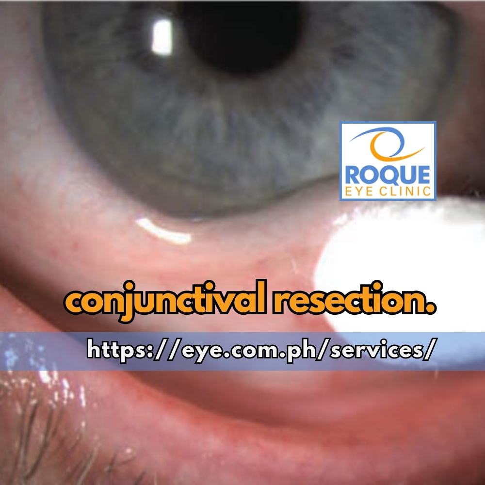 Conjunctival resection - ROQUE Eye Clinic | Eye.com.ph