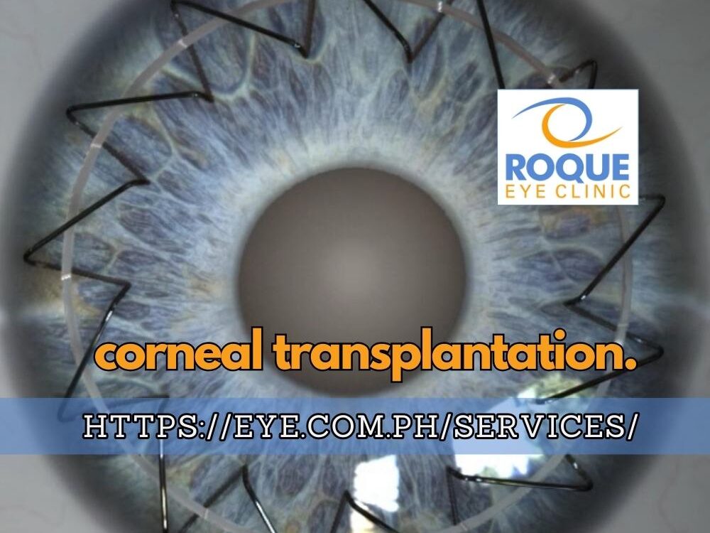 Bevacizumab (AVASTIN) Anti-VEGF Intravitreal Injection