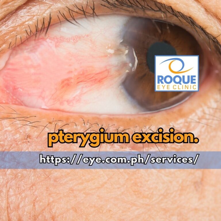 Pterygium Excision | One Eye - ROQUE Eye Clinic | Eye.com.ph