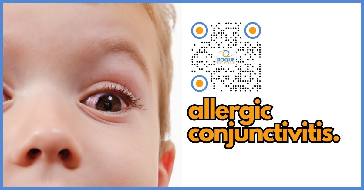 Conquering Allergic Conjunctivitis: Insights from Roque Eye Clinic - ROQUE Eye Clinic | Eye.com.ph