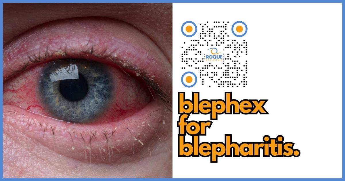Effective Blepharitis Management: Understanding and Treating with BlephEx™