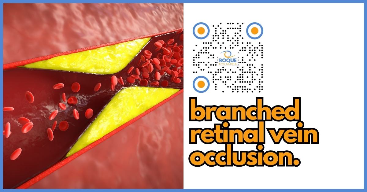 Understanding Branch Retinal Vein Occlusion: Causes, Symptoms, and ...