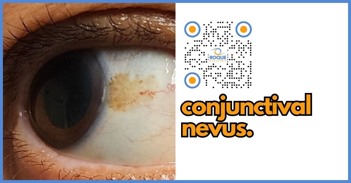 Conjunctival Nevus: Causes, Symptoms, Treatment & Prevention - ROQUE Eye Clinic | Eye.com.ph