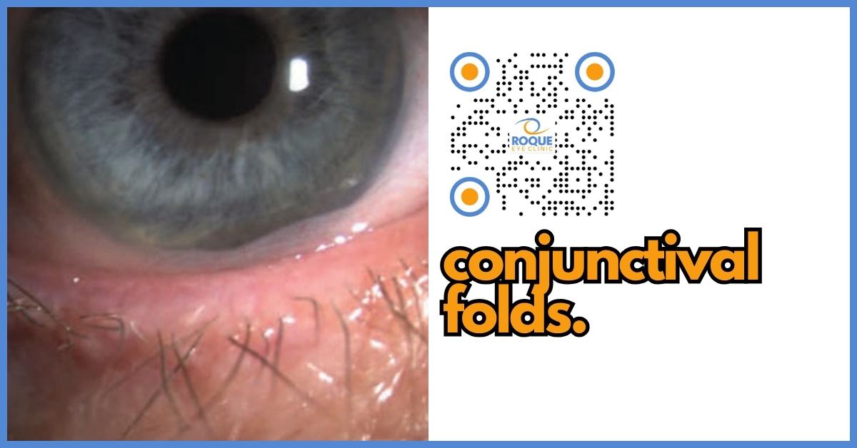 Easing the Discomfort of Conjunctivochalasis: A Path to Clarity and ...