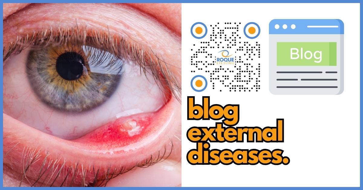 BLOG | The Eye Blog | ROQUE Eye Clinic | Manila, Philippines