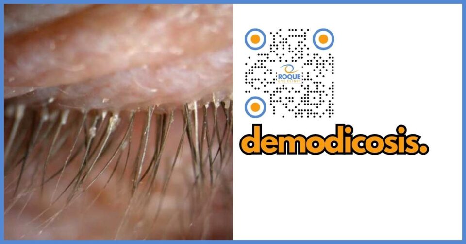 Demodicosis: Understanding and Managing Eye Mite Infections - ROQUE Eye ...