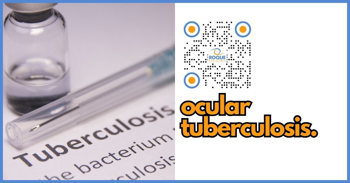 Tuberculosis and the Eye: A Comprehensive Guide - ROQUE Eye Clinic ...
