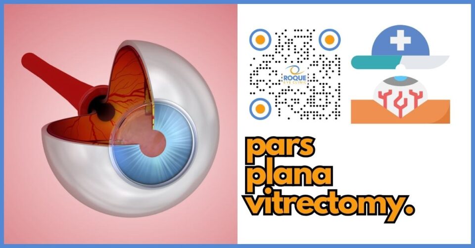 Comprehensive Guide to Pars Plana Vitrectomy (PPV) - ROQUE Eye Clinic | Eye.com.ph