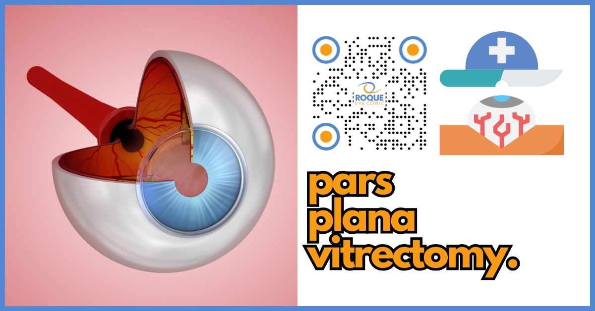 Comprehensive Guide to Pars Plana Vitrectomy (PPV) - ROQUE Eye Clinic ...