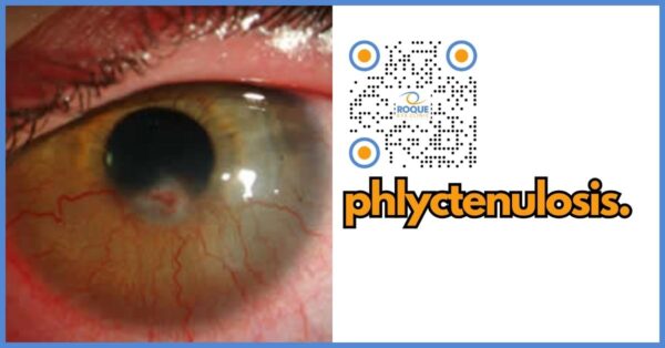 Understanding Phlyctenulosis: Causes, Symptoms, Treatment, and Prevention