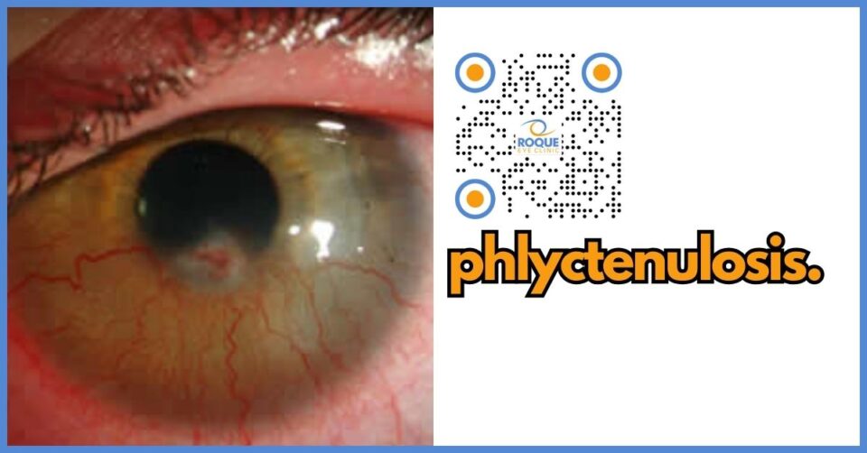 Understanding Phlyctenulosis: Causes, Symptoms, Treatment, and Prevention