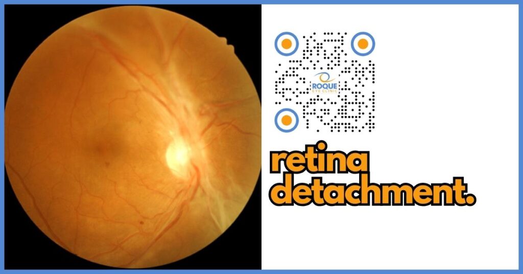 Retinal Detachment: A Comprehensive Patient Guide - ROQUE Eye Clinic ...