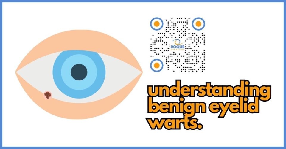 Understanding Benign Eyelid Warts: A Comprehensive Guide - ROQUE Eye ...