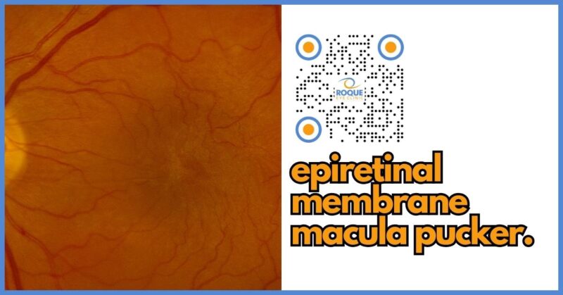 Understanding Epiretinal Membrane or Macular Pucker: A Comprehensive ...