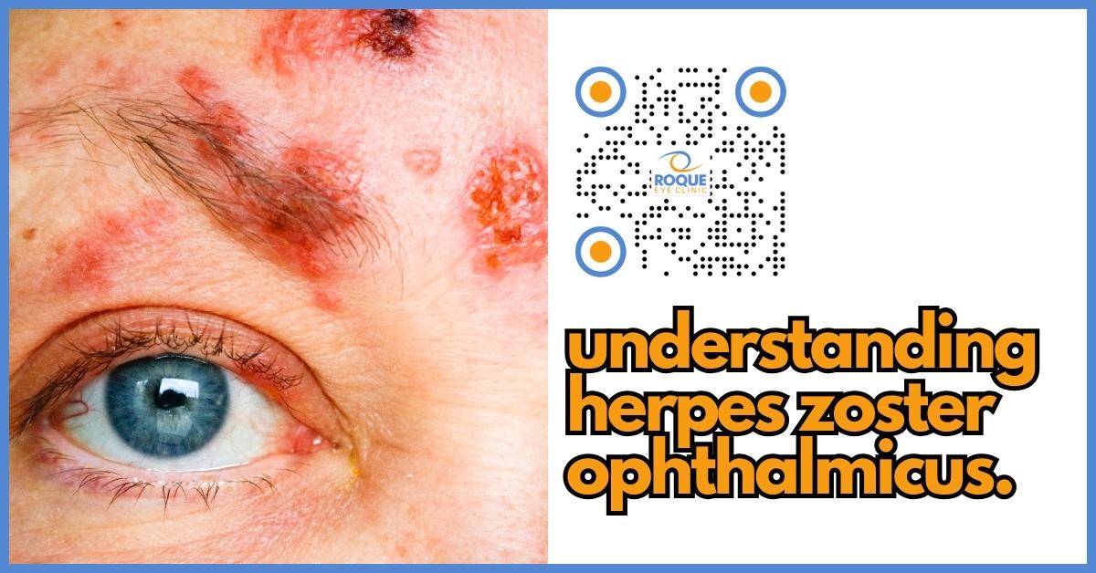 Understanding Herpes Zoster Ophthalmicus: Symptoms, Treatment, and ...