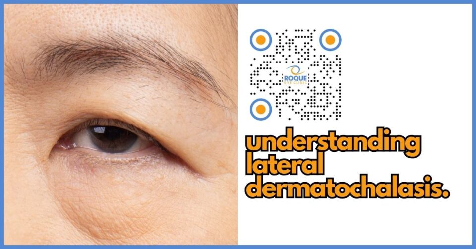 Unveiling Lateral Dermatochalasis: A Comprehensive Guide - ROQUE Eye ...