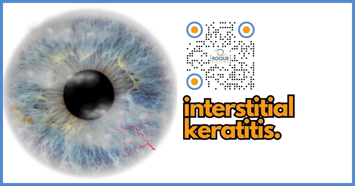 Keratitis