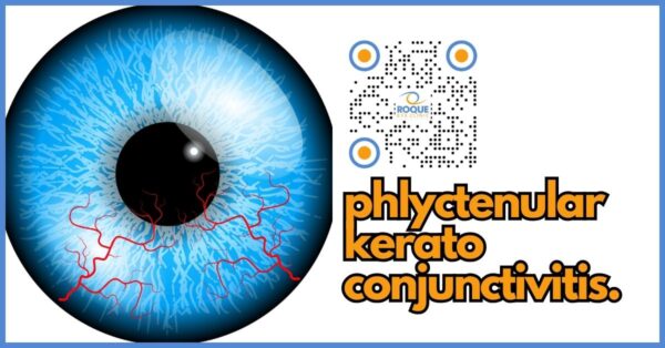 Phlyctenular Keratoconjunctivitis: A Comprehensive Guide for Patients