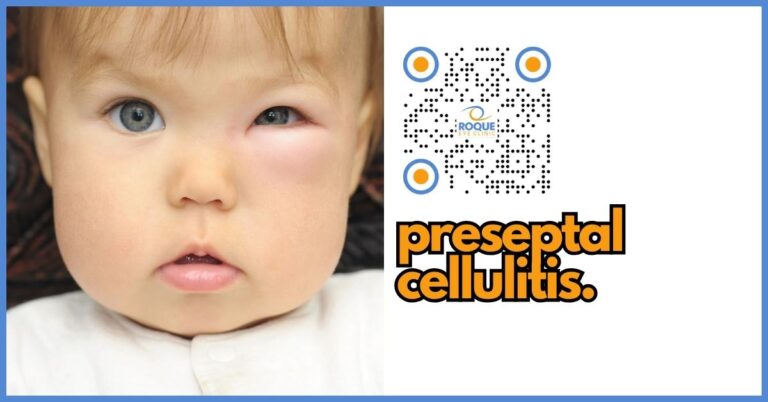 Preseptal Cellulitis: Comprehensive Patient Guide - ROQUE Eye Clinic ...