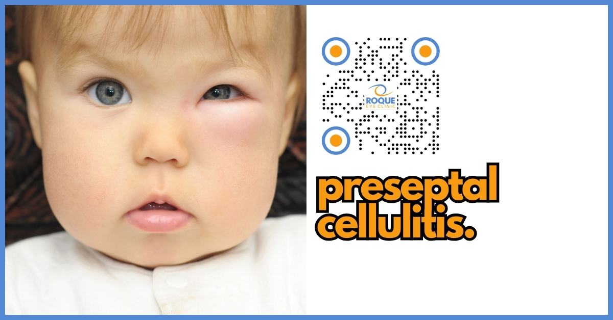 Periorbital Cellulitis Contagious