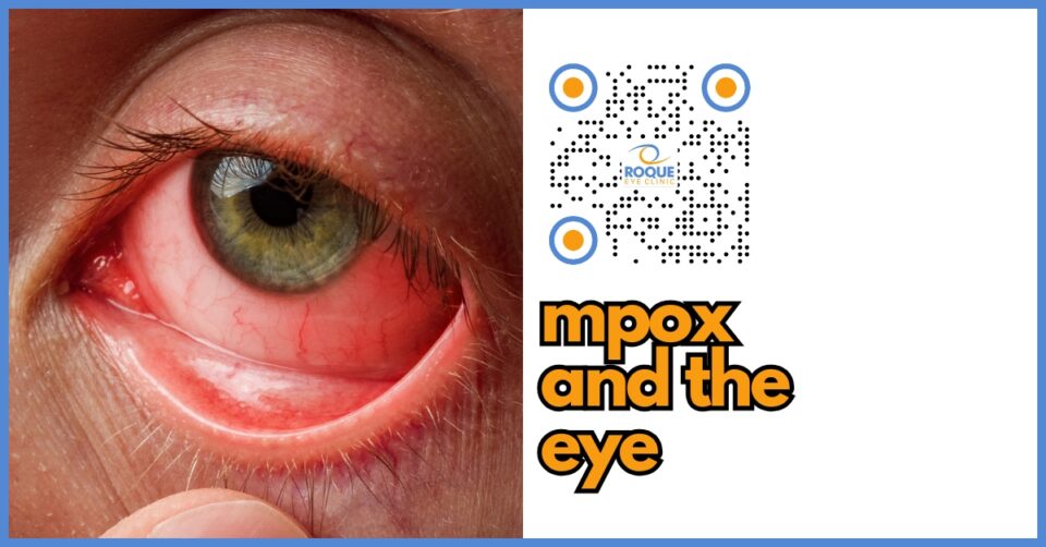 Understanding the Ocular Manifestations of Mpox: Symptoms, Prevention ...