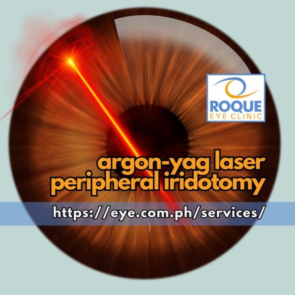 Argon-YAG Laser Peripheral Iridotomy - ROQUE Eye Clinic | Eye.com.ph